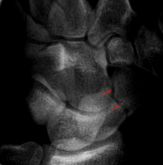 Schaphoidfraktur - NHI.no