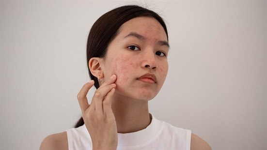 Akne, behandling - NHI.no