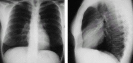 Lungeemboli - røntgen - NHI.no