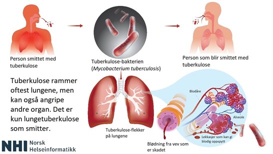 Tuberkulose, lunge, oversikt - Diagnostikk - NHI.no