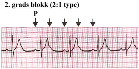 Hjertearytmi - NHI.no